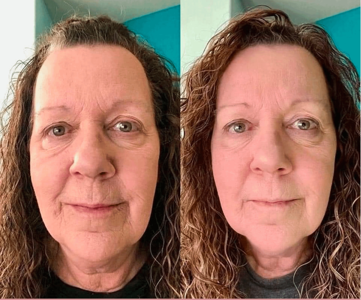 Liquid Collagen – Acupuncture